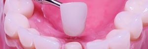 Fresno Dental Crowns and Bridges Dental Treatment by Milburn Dental